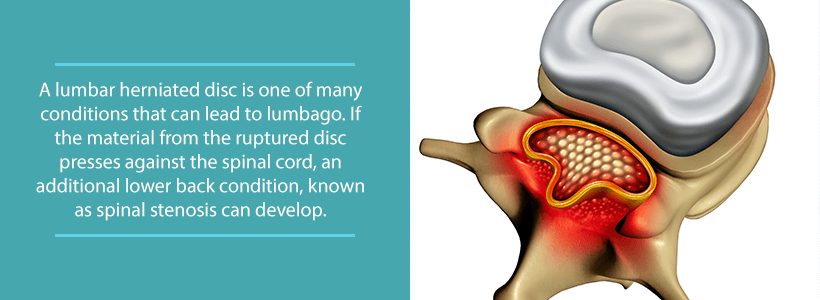What is Lumbago? Causes & Symptoms | Orthopedic & Laser Spine